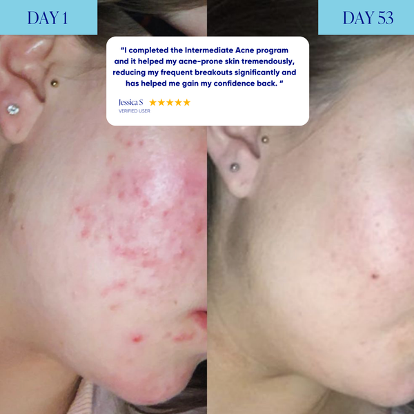 Intermediate Acne Program™ – PuraU