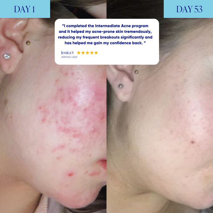 Intermediate Acne Program™ – PuraU