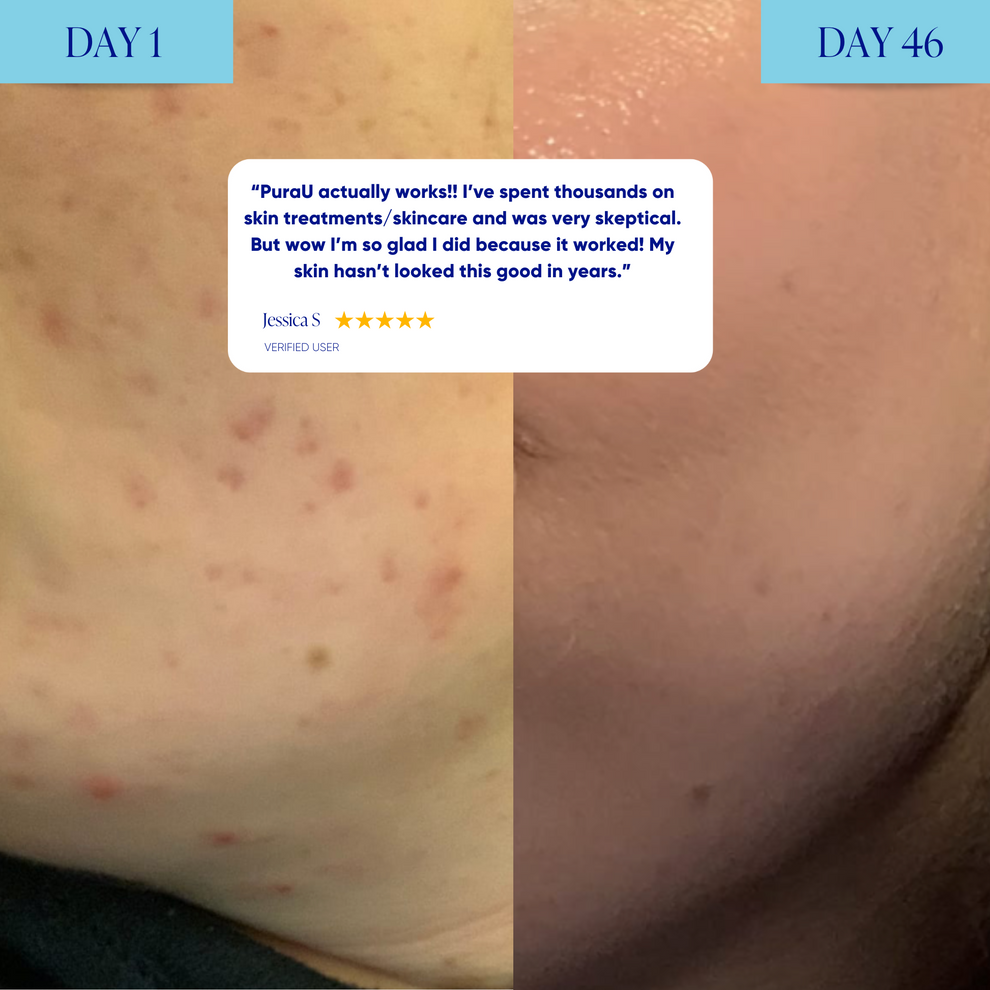 Intermediate Acne Program™ – PuraU
