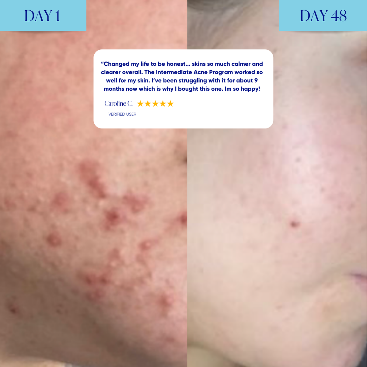 Intermediate Acne Program™ – PuraU