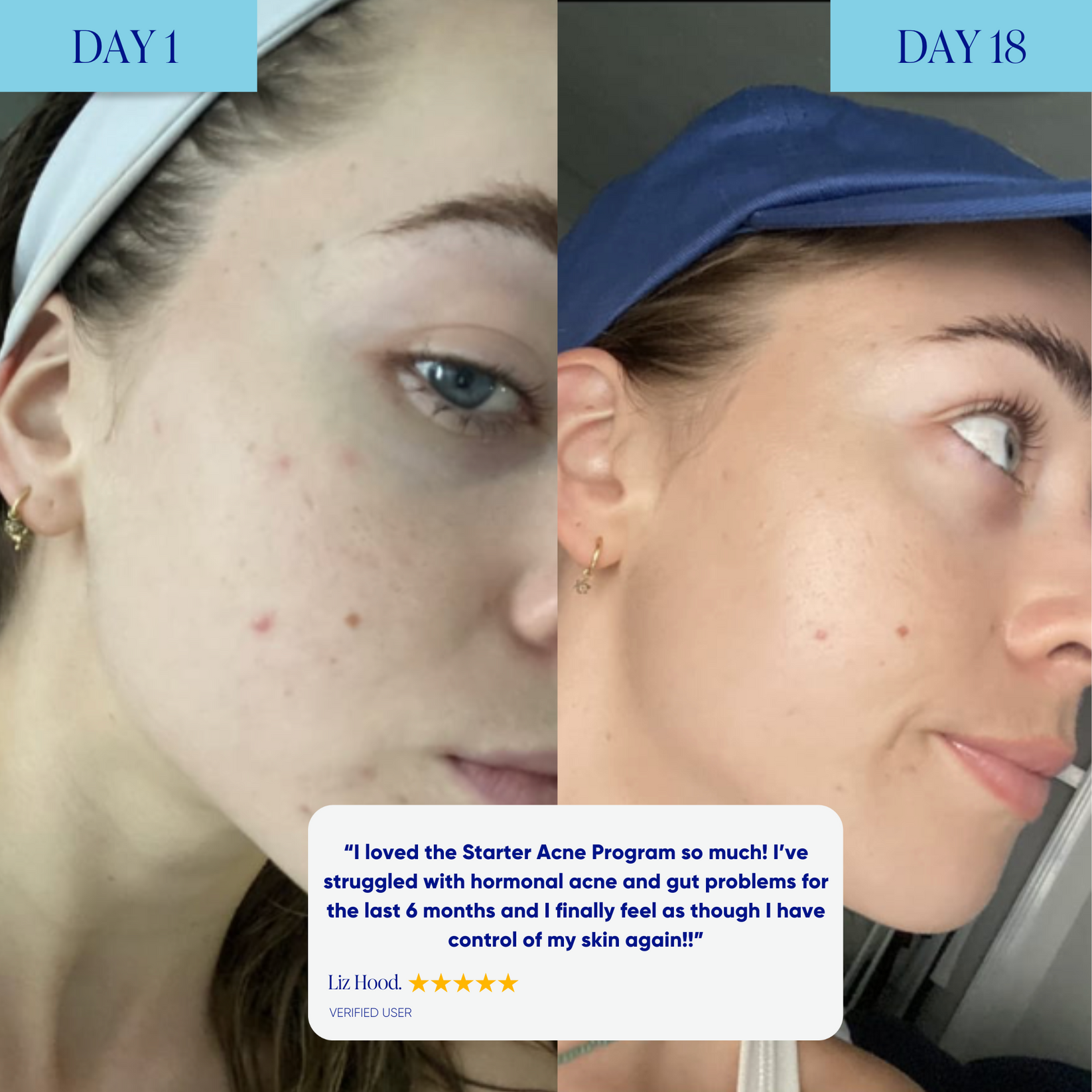 Starter Acne Program™ – PuraU
