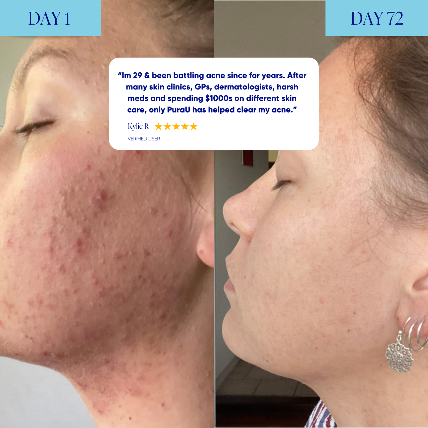 Advanced Acne Program™ – PuraU
