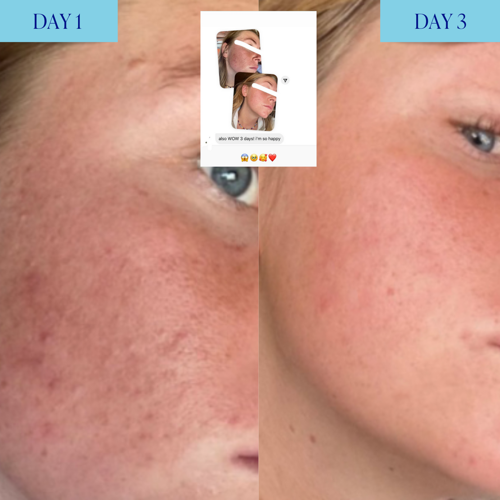 Starter Acne Program™ – PuraU