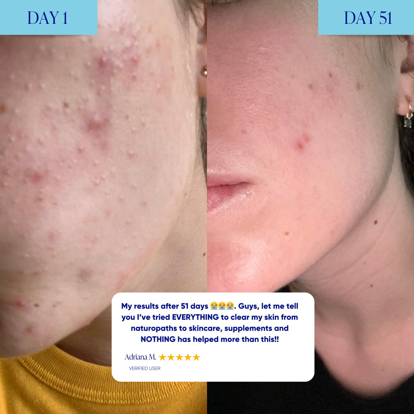 Intermediate Acne Program™ – PuraU