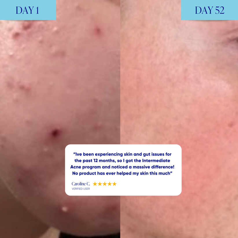 Intermediate Acne Program™ – PuraU
