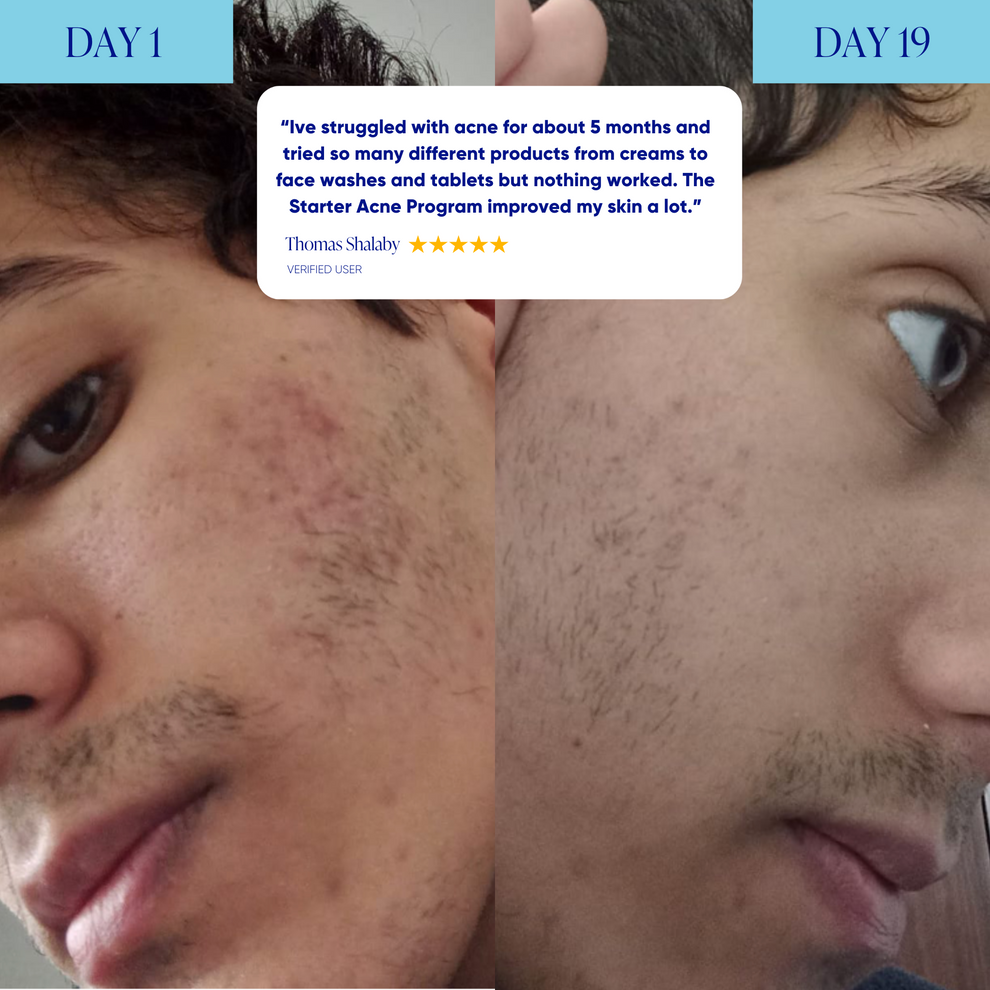 Starter Acne Program™ – PuraU