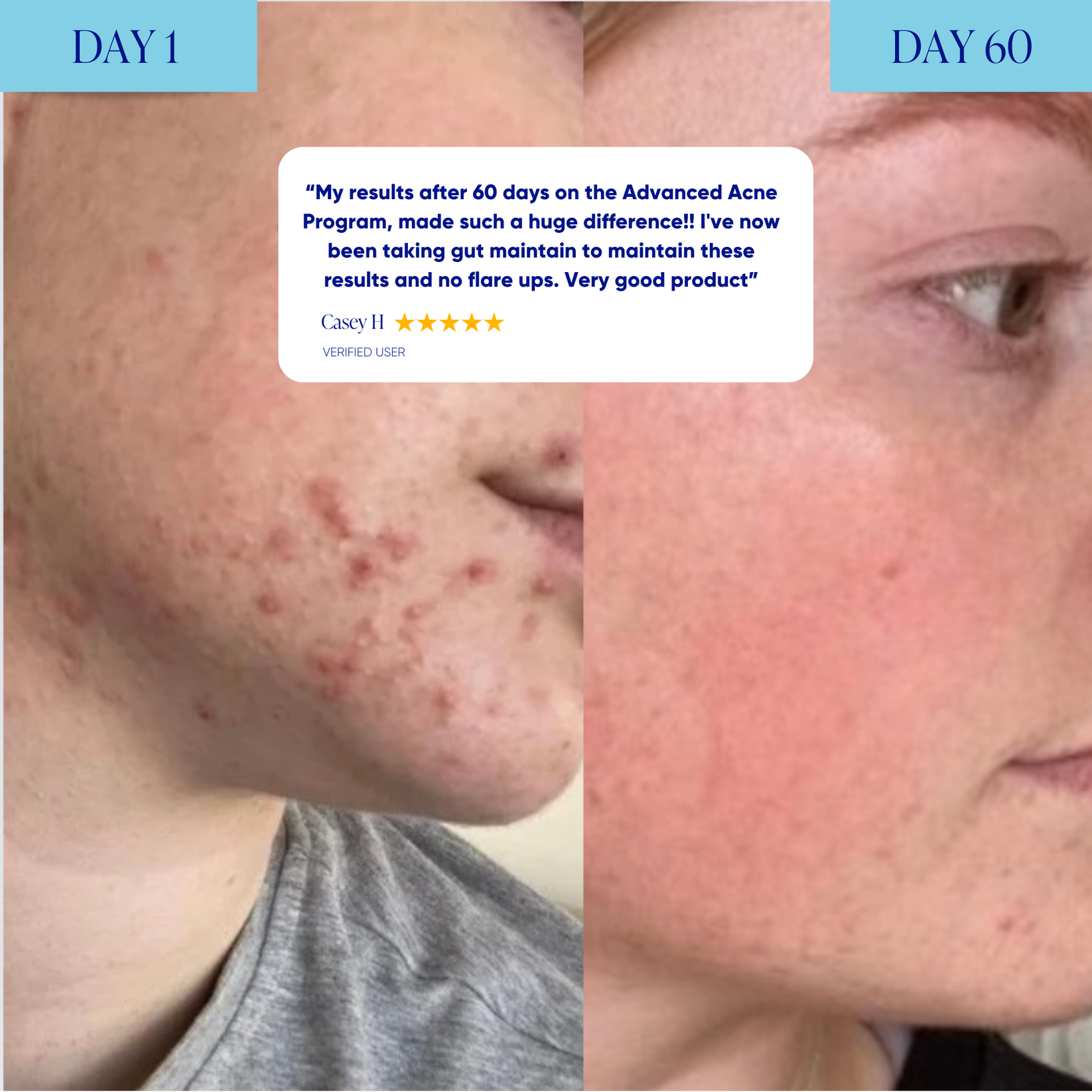 Advanced Acne Program™ – PuraU
