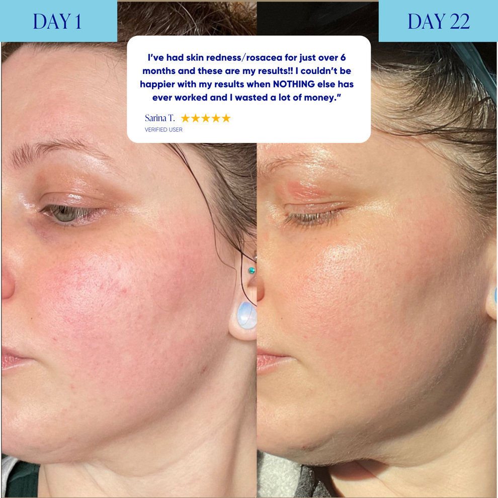 Starter Acne Program™ – PuraU