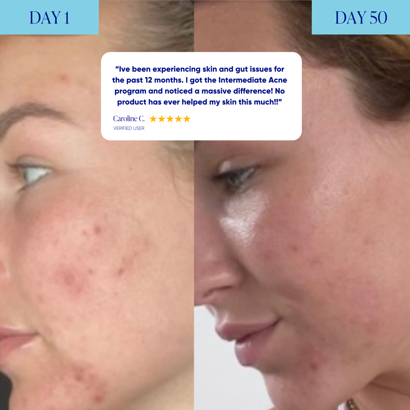 Intermediate Acne Program™ – PuraU