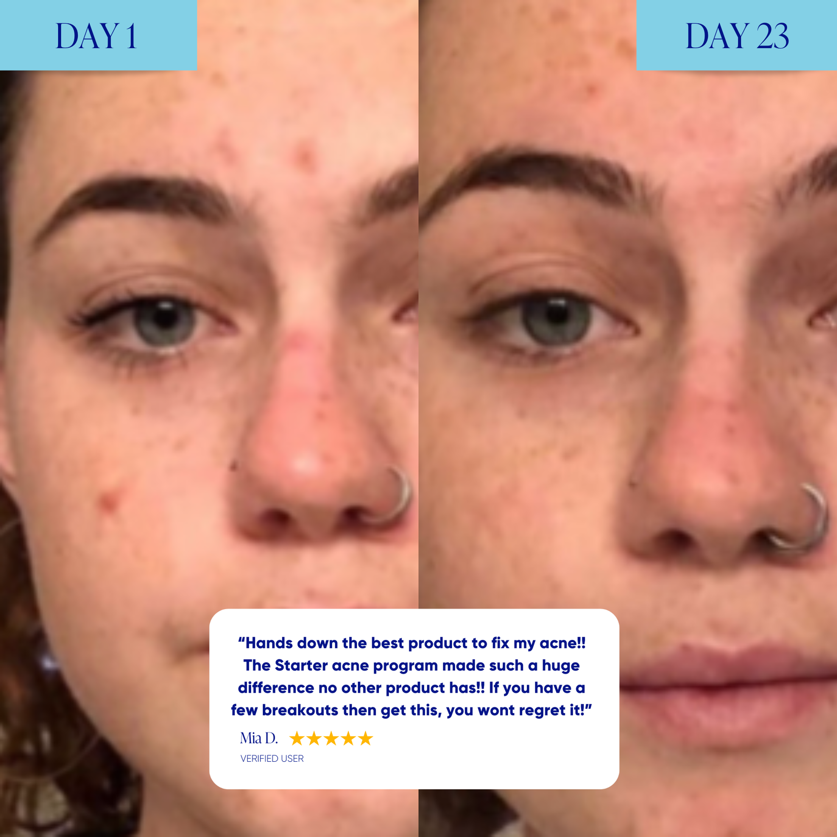 Starter Acne Program™ – PuraU