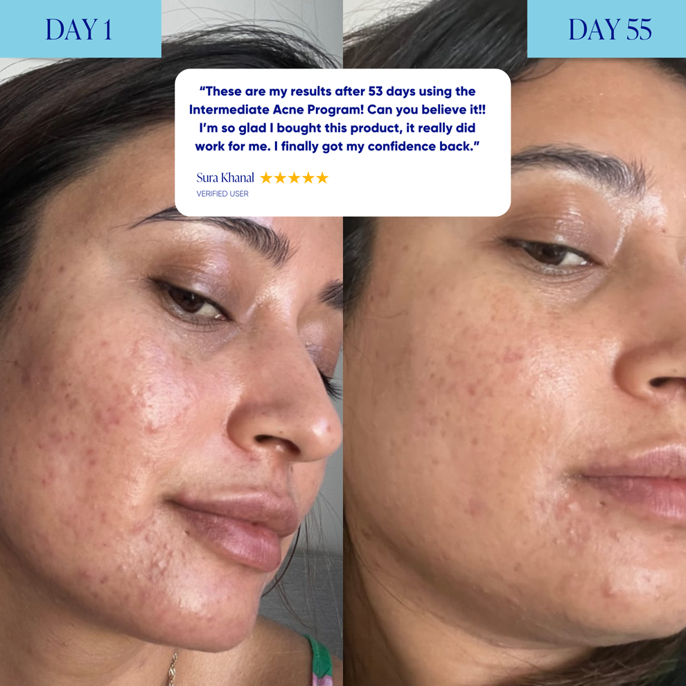 Intermediate Acne Program™ – PuraU